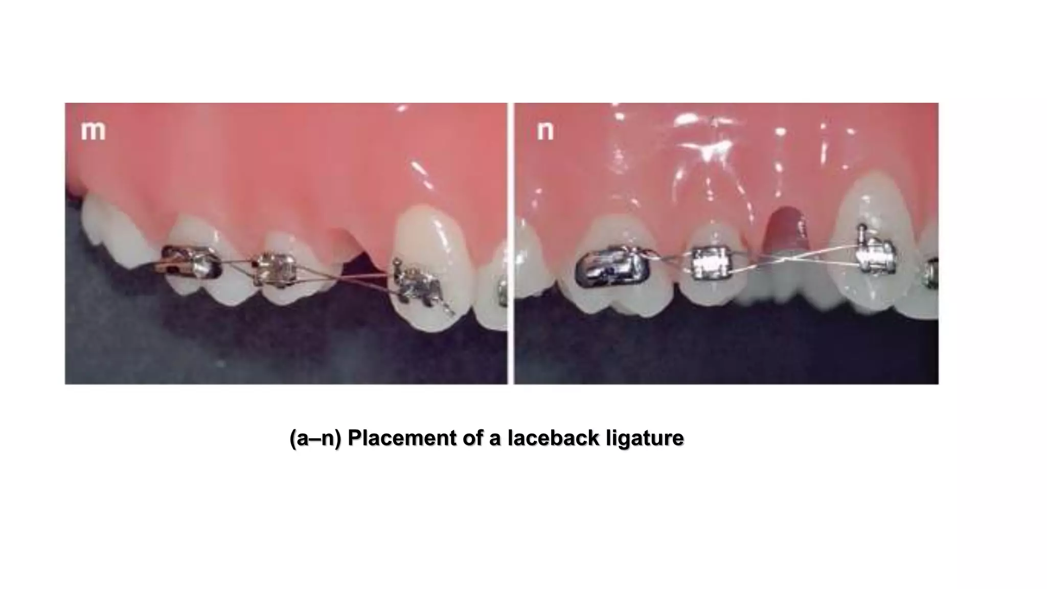 Orthodontic initial alignment of teeth | PPT