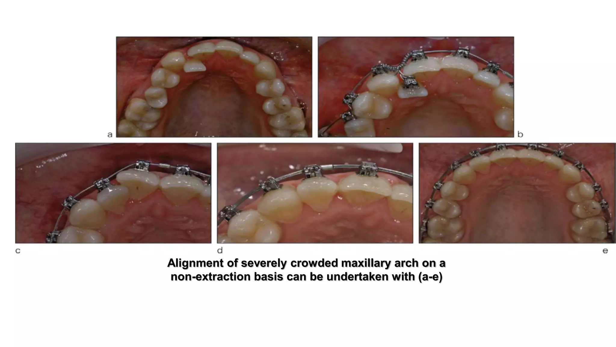 Orthodontic initial alignment of teeth | PPT