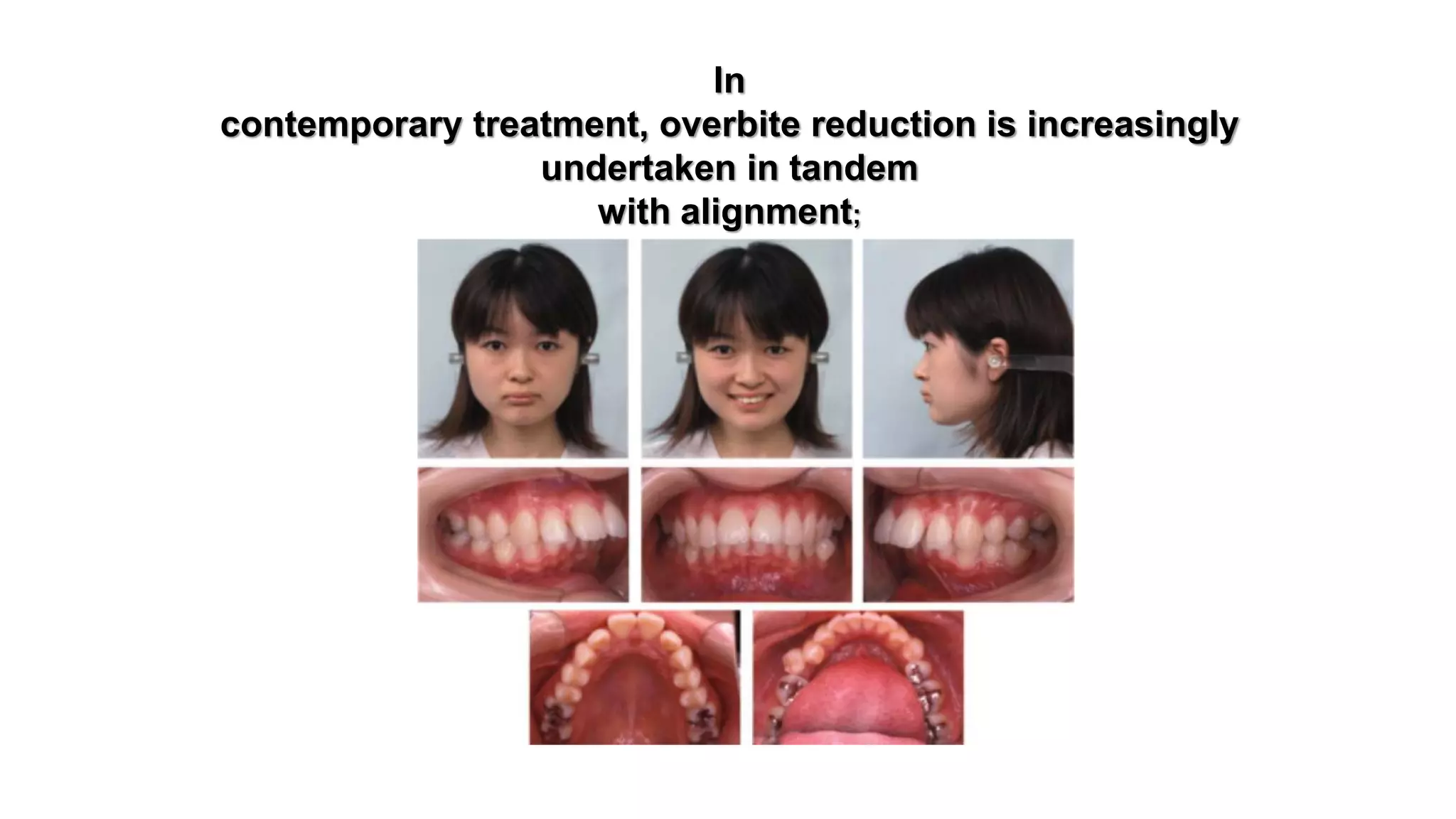 Orthodontic initial alignment of teeth | PPT