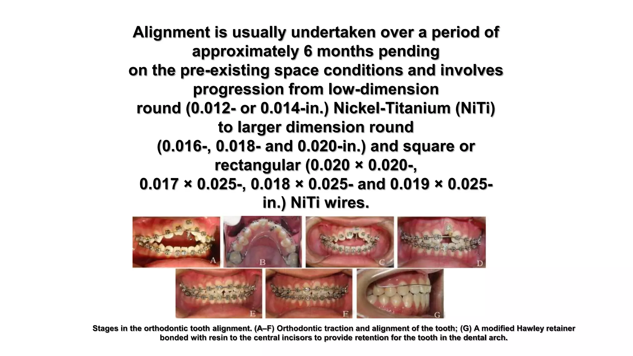 Orthodontic initial alignment of teeth | PPT