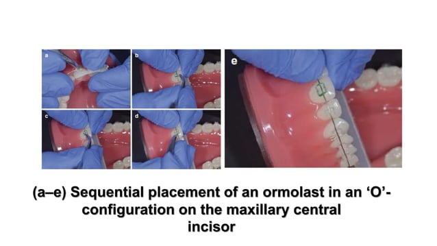 Orthodontic initial alignment of teeth | PPT