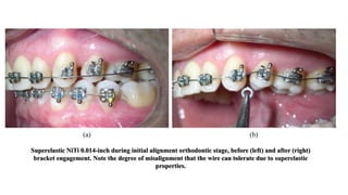 Orthodontic initial alignment of teeth | PPTX