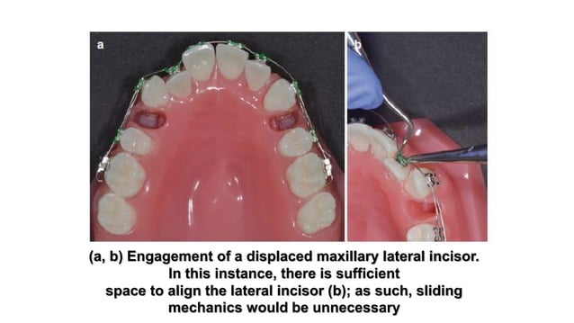Orthodontic initial alignment of teeth | PPT