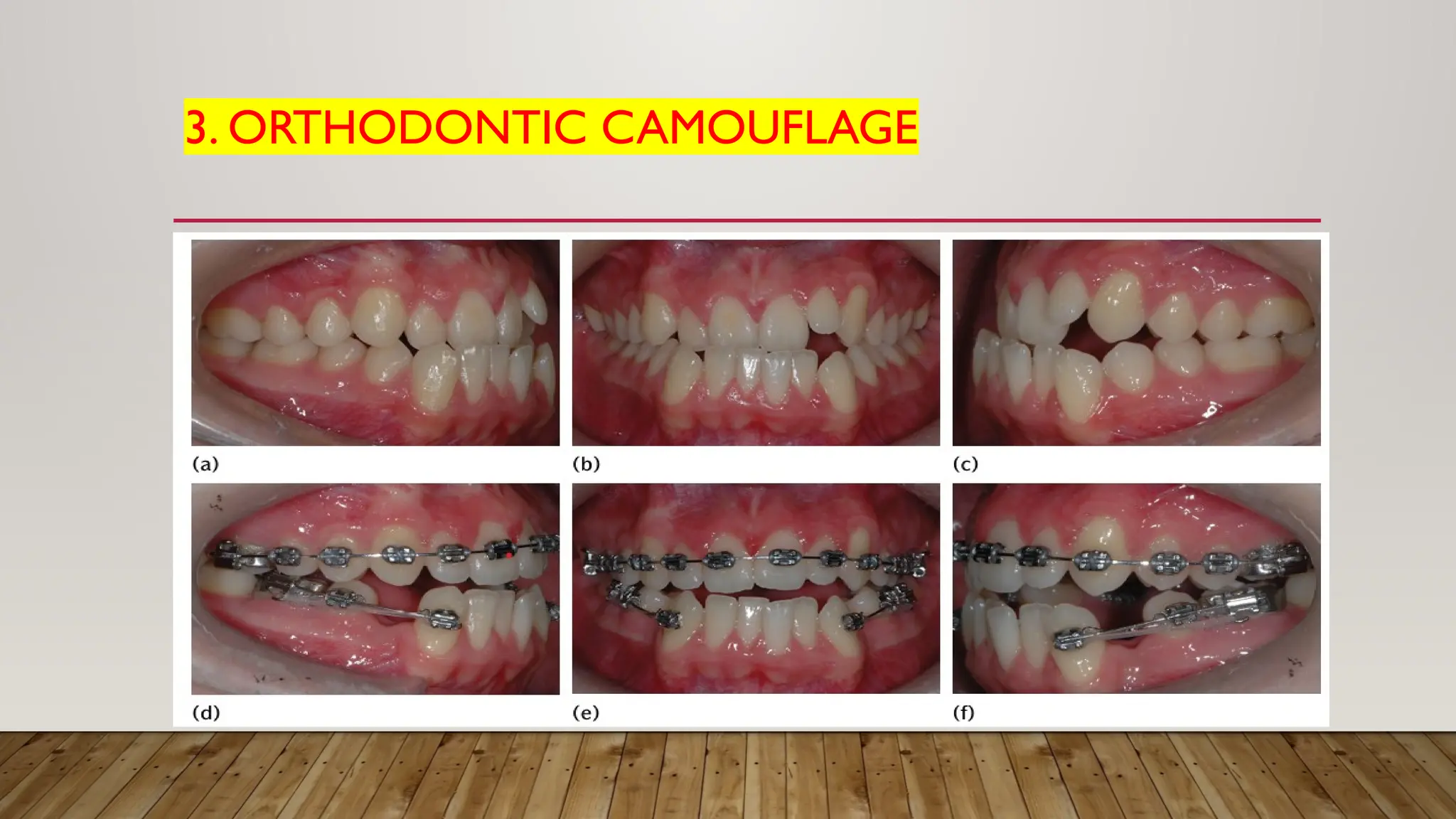 ORTHODONTIC Management of Class III Malocclusion.pptx