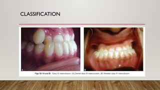 ORTHODONTIC Management of Class III Malocclusion.pptx