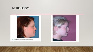 ORTHODONTIC Management of Class III Malocclusion.pptx