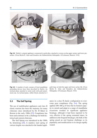 Orthodontic Management of Class II Malocclusion.pdf