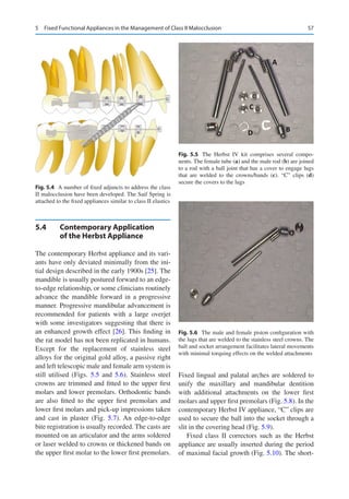 Orthodontic Management of Class II Malocclusion.pdf