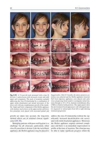 Orthodontic Management of Class II Malocclusion.pdf