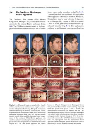 Orthodontic Management of Class II Malocclusion.pdf