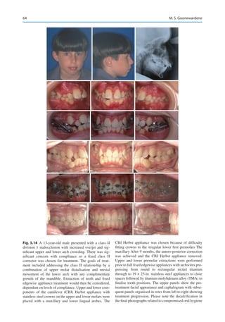 Orthodontic Management of Class II Malocclusion.pdf