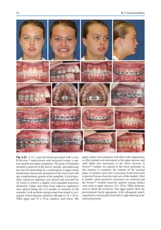 Orthodontic Management of Class II Malocclusion.pdf