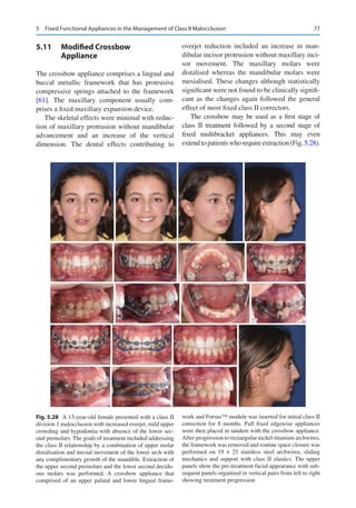 Orthodontic Management of Class II Malocclusion.pdf