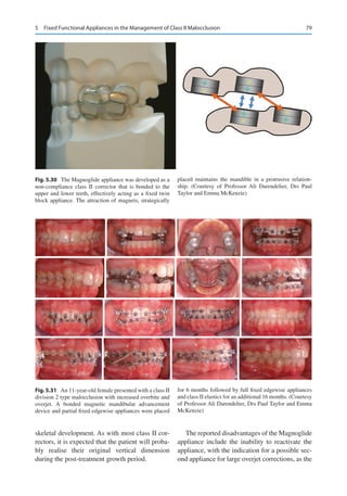 Orthodontic Management of Class II Malocclusion.pdf