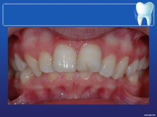Orthodontic MANAGEMENT OF DEEP BITE.pptx