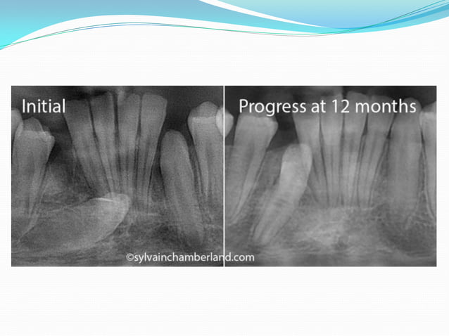 Orthodontic management of impacted canines | PDF | Dental Health ...