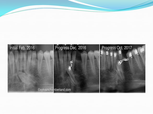 Orthodontic management of impacted canines | PDF | Dental Health ...