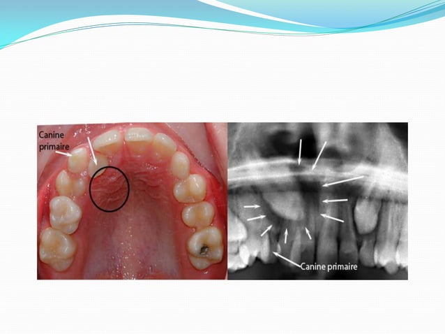 Orthodontic management of impacted canines | PDF | Dental Health ...