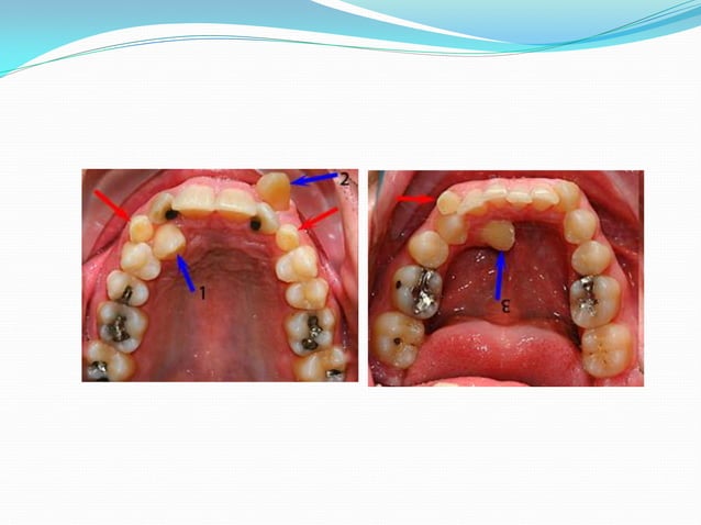 Orthodontic management of impacted canines | PDF | Dental Health ...