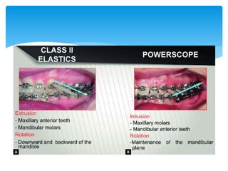 Orthodontic materials & instruments | PPTX