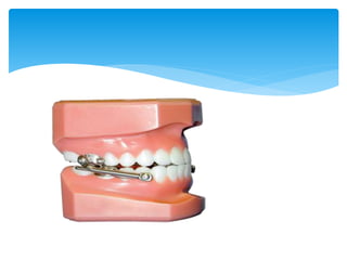 Orthodontic materials & instruments | PPTX