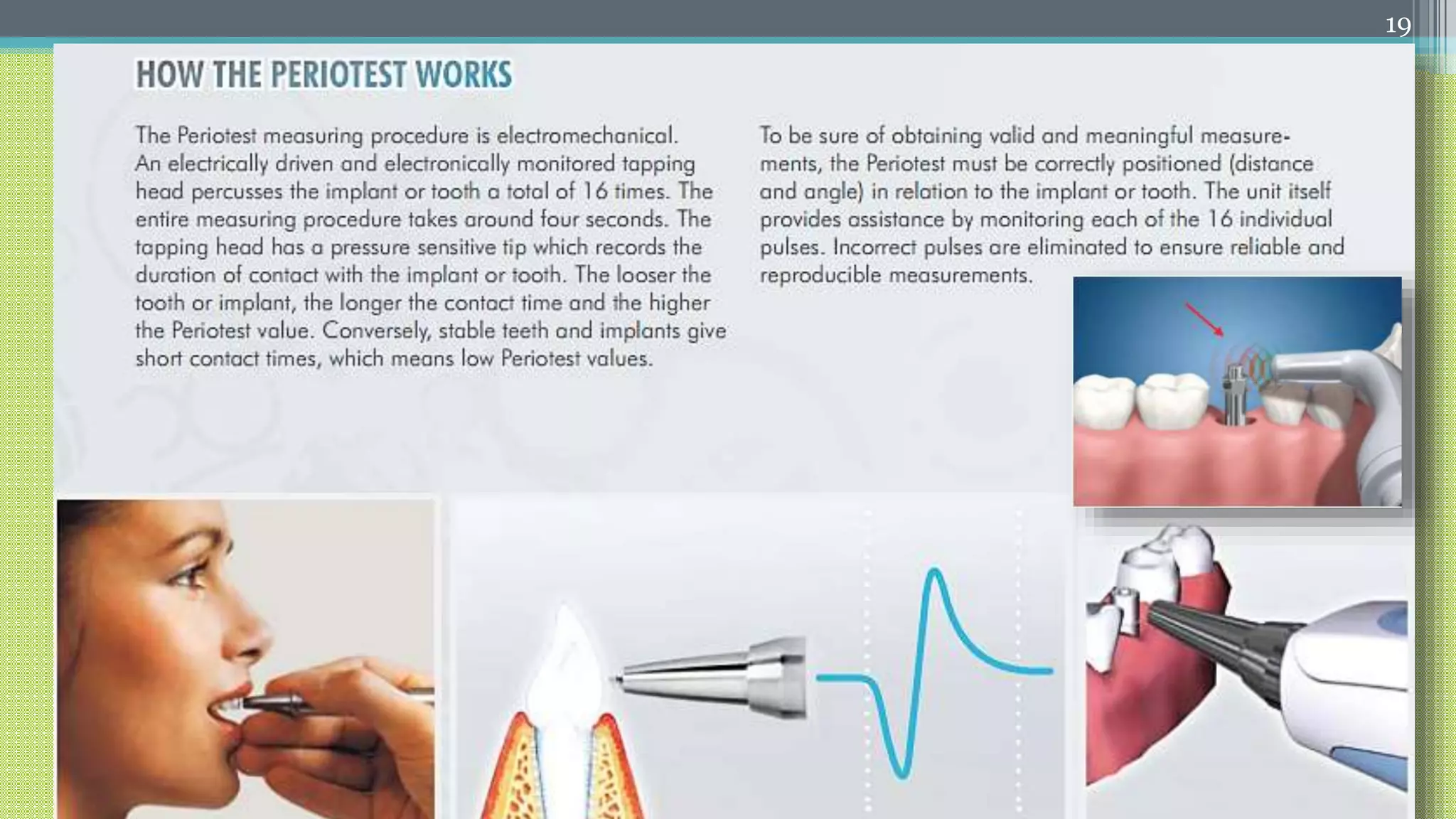 Orthodontic mini implant | PPTX