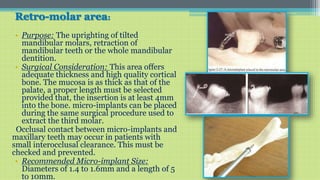 Orthodontic mini implant | PPTX