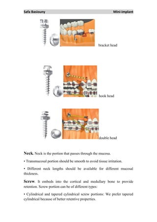 Exploring Materials for Orthodontic Mini-Implants: A Comprehensive ...