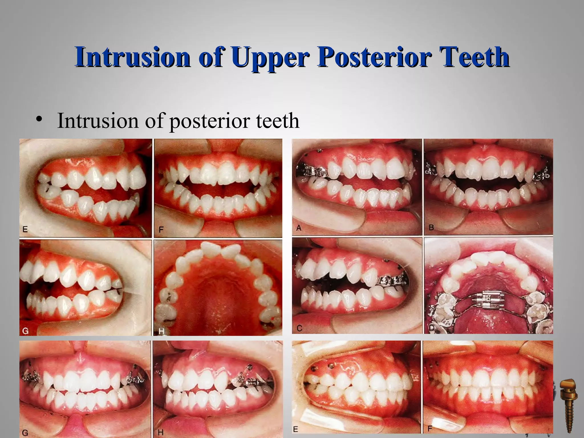Orthodontic miniscrew implants | PPT