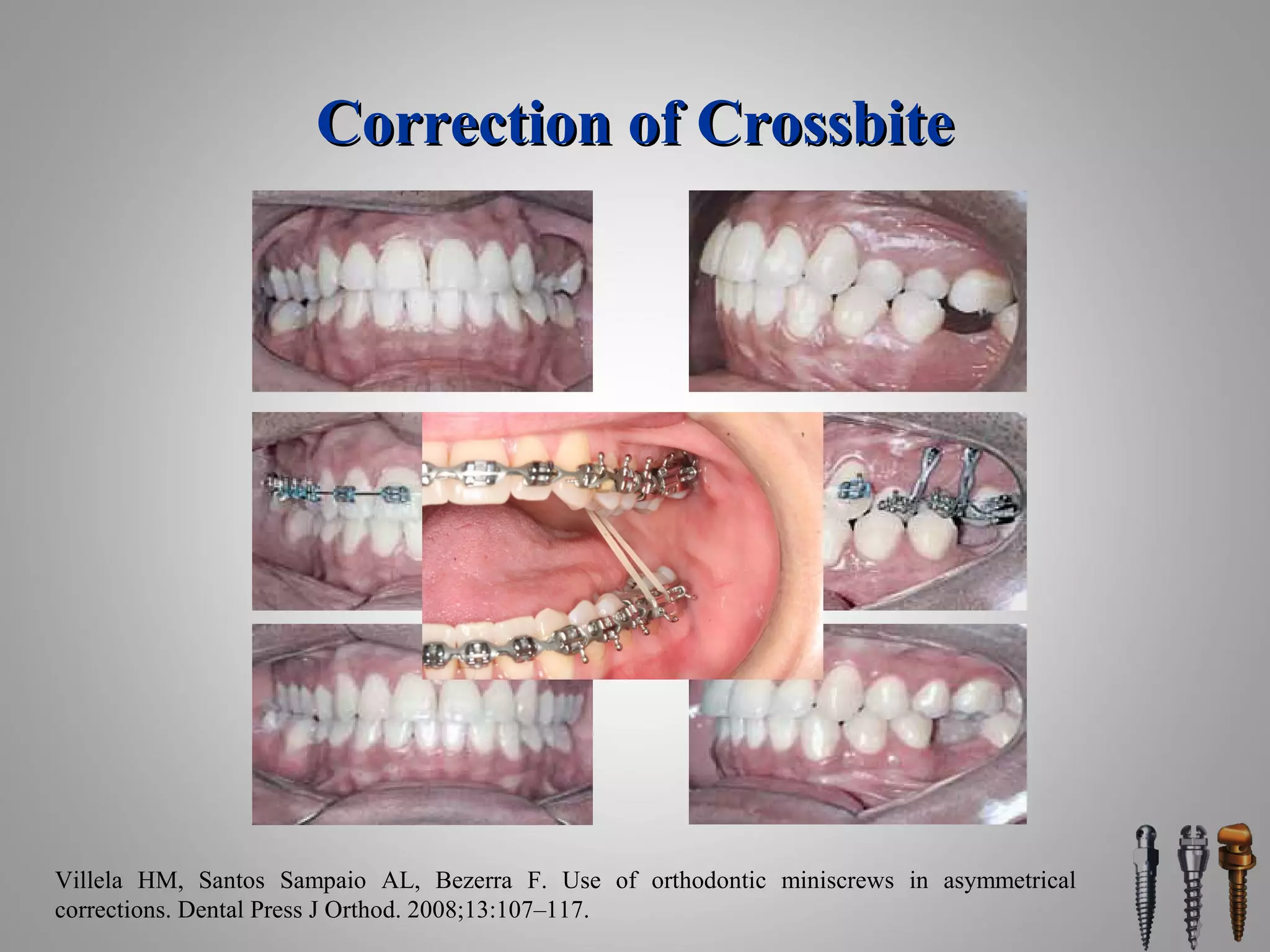 Orthodontic miniscrew implants | PPT