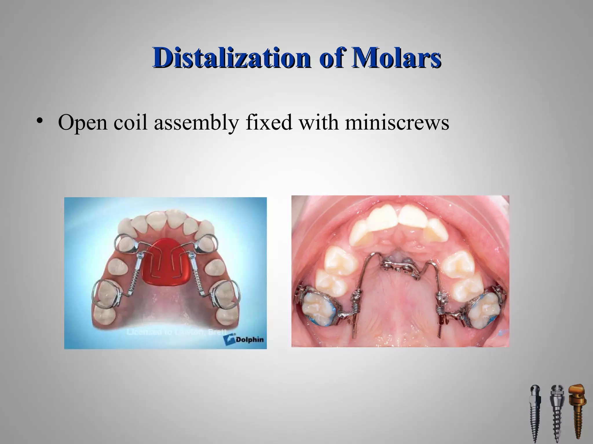 Orthodontic miniscrew implants | PPT