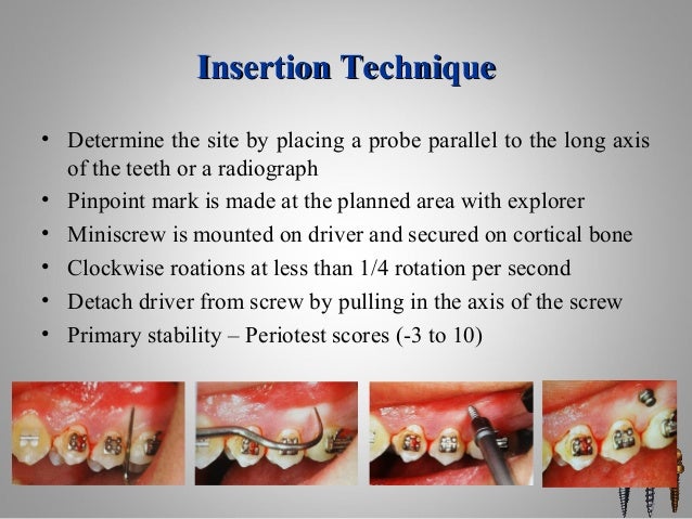 Orthodontic miniscrew implants