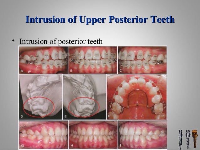 Orthodontic miniscrew implants