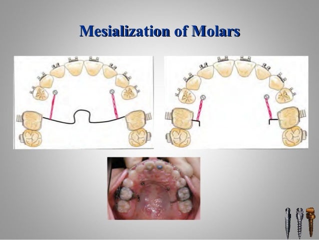 Orthodontic miniscrew implants