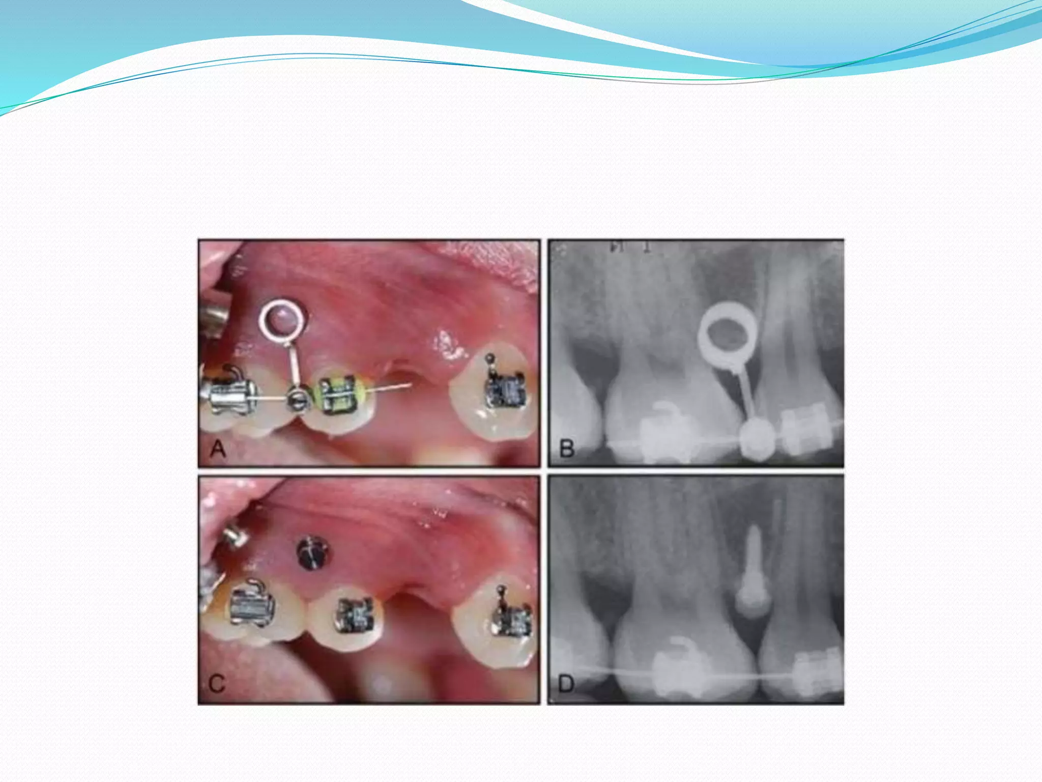 Orthodontic miniscrew ( TAD ) placement | PPTX