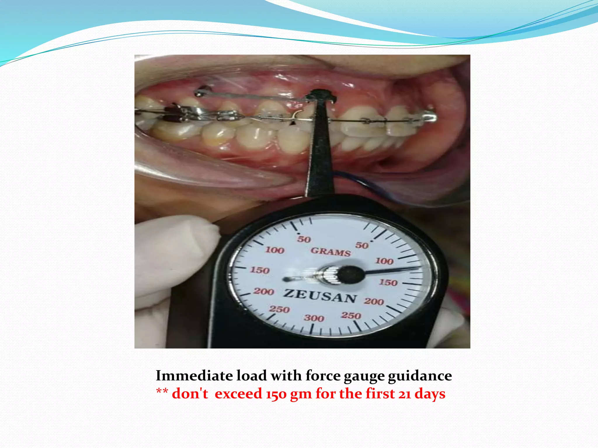 Orthodontic miniscrew ( TAD ) placement | PPTX