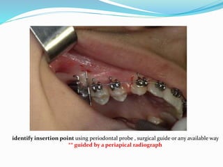 Orthodontic miniscrew ( TAD ) placement | PPTX