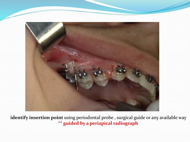 Orthodontic miniscrew ( TAD ) placement | PPTX