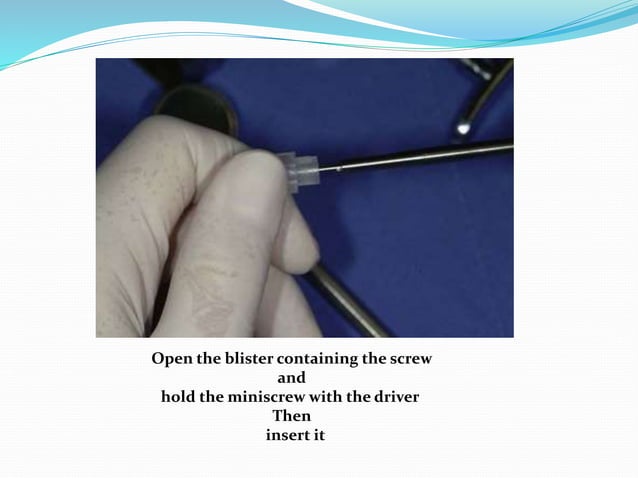 Orthodontic miniscrew ( TAD ) placement | PPTX