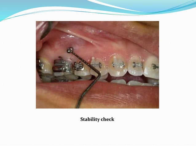 Orthodontic miniscrew ( TAD ) placement | PPTX