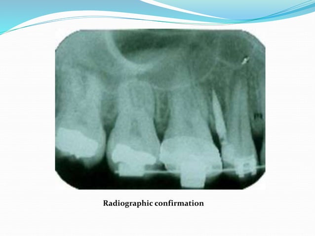 Orthodontic miniscrew ( TAD ) placement | PPTX