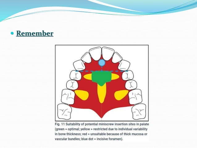 Orthodontic miniscrew ( TAD ) placement | PPTX