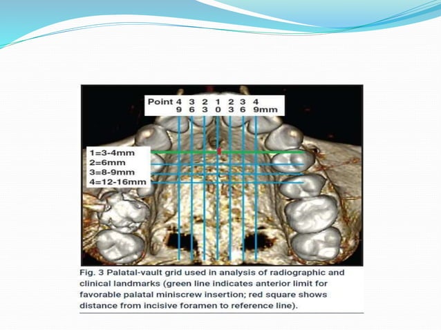 Orthodontic miniscrew ( TAD ) placement | PPTX