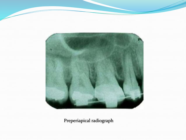 Orthodontic miniscrew ( TAD ) placement | PPTX