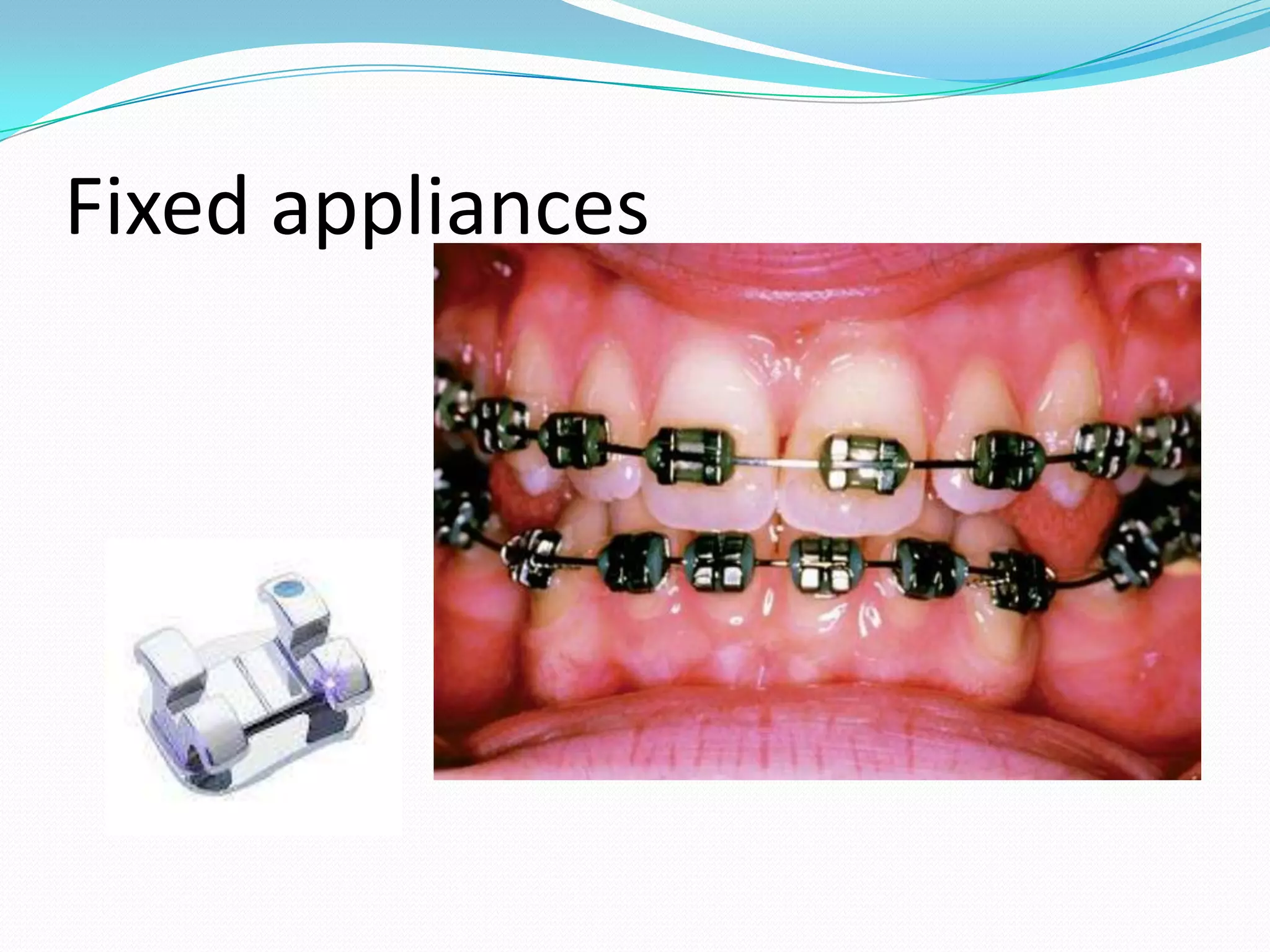 Orthodontic removable appliances