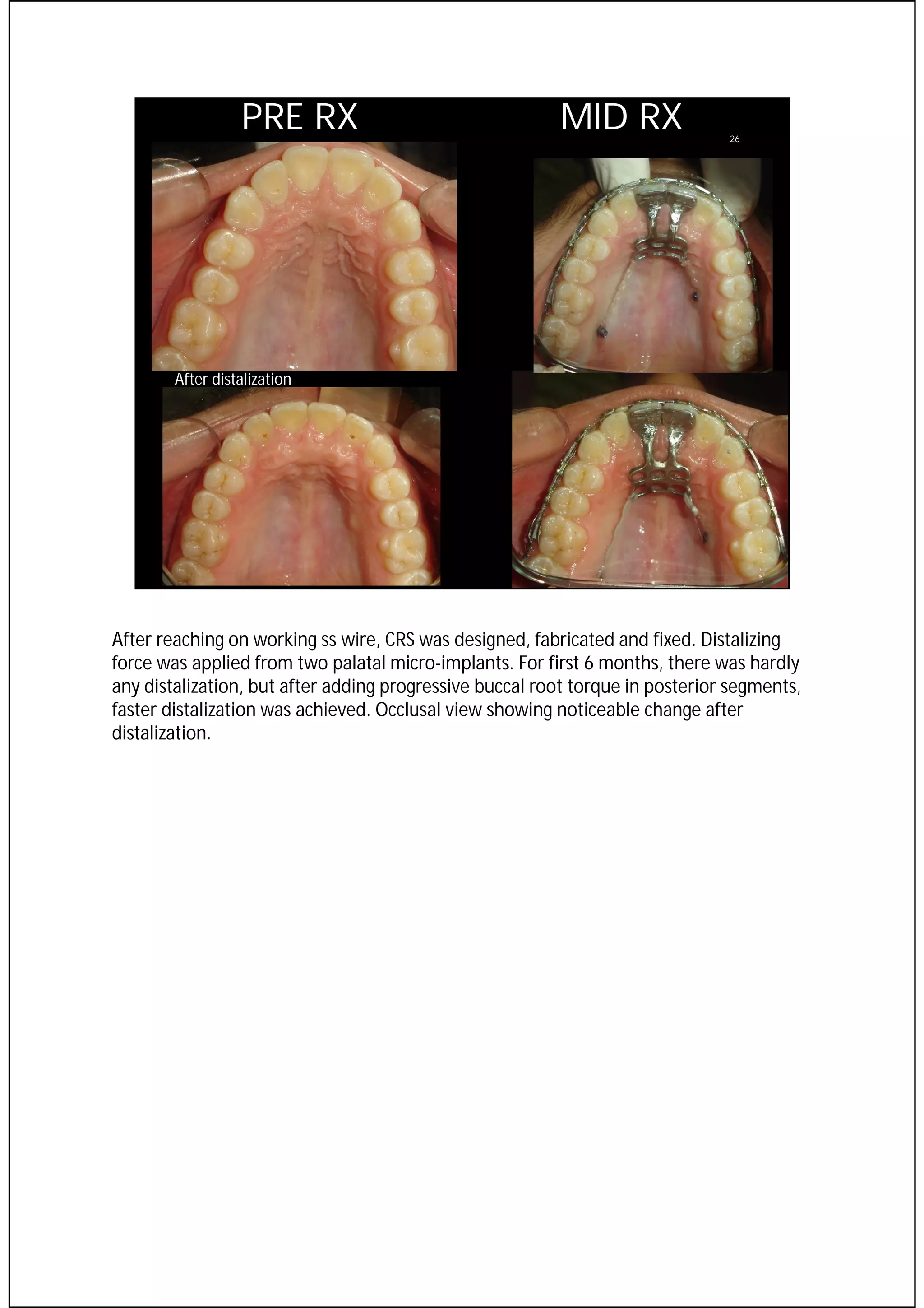 Orthodontic retraction biomechanics for space closure and distalization ...