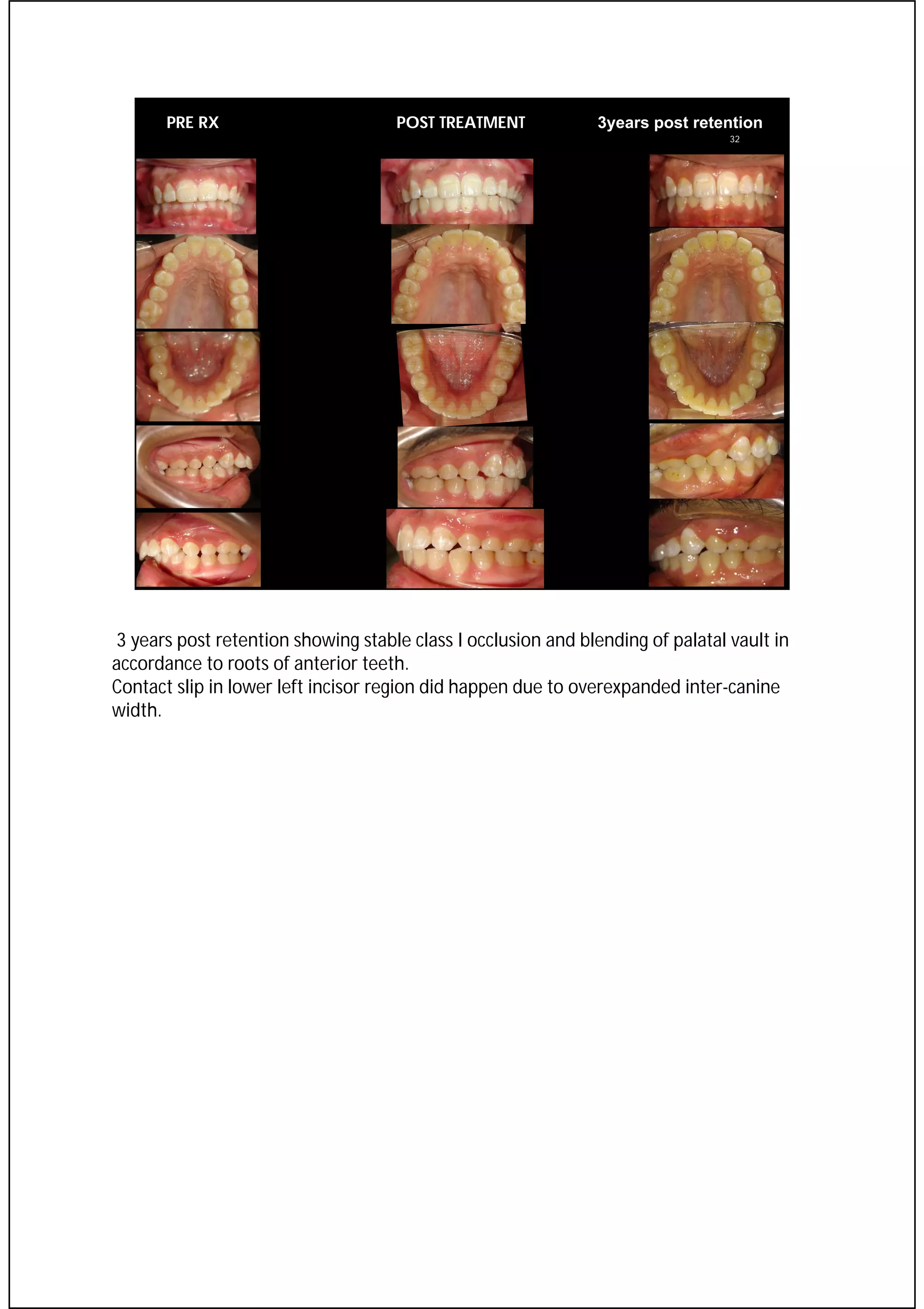 Orthodontic retraction biomechanics for space closure and distalization ...