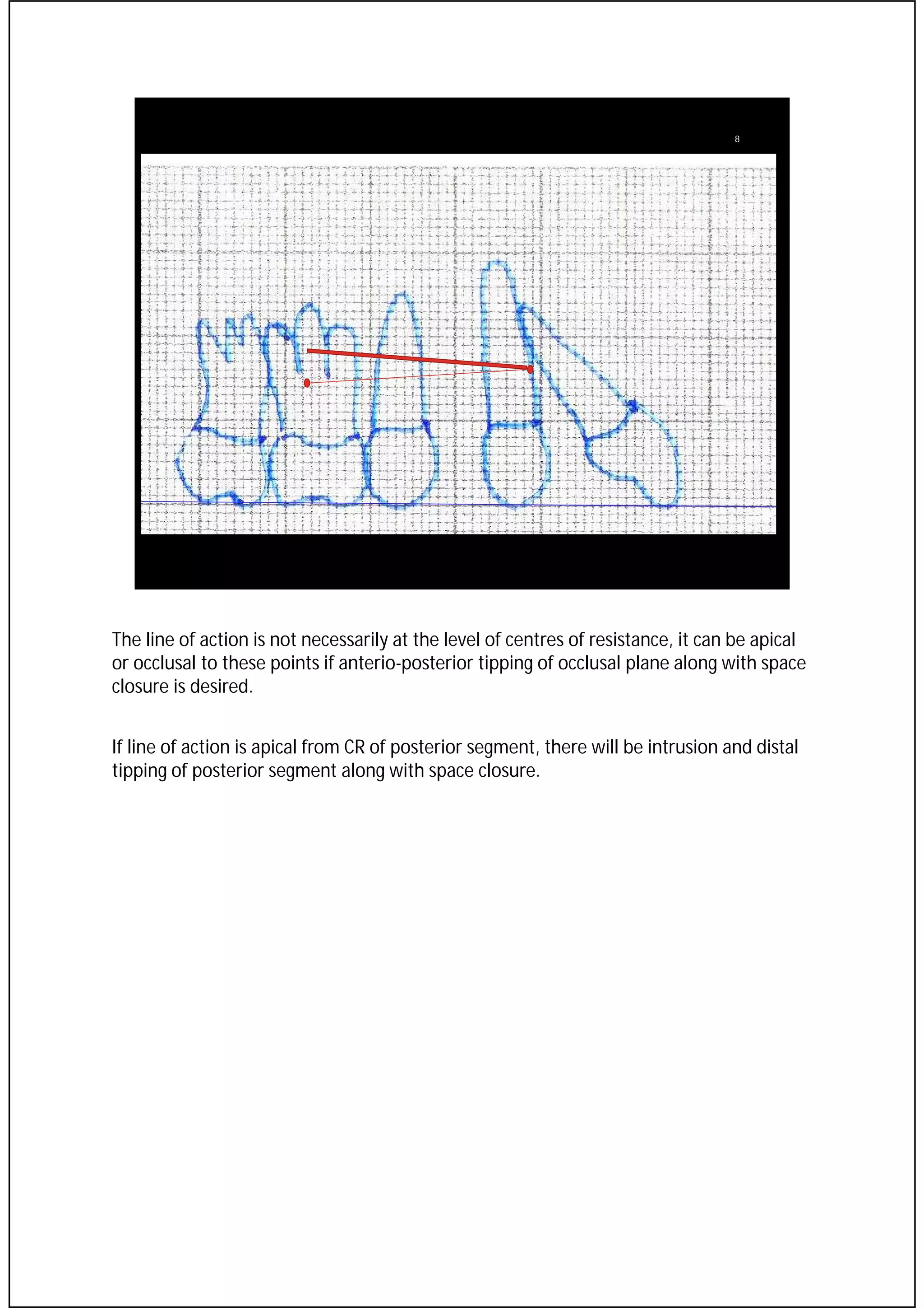 Orthodontic retraction biomechanics for space closure and distalization ...