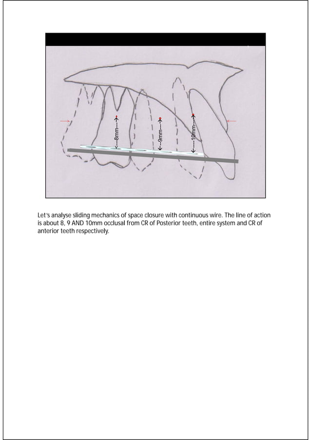 Orthodontic retraction biomechanics for space closure and distalization ...