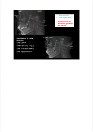 Orthodontic retraction biomechanics for space closure and distalization ...